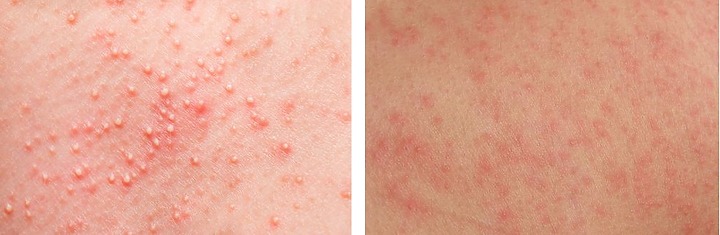 Scabs on Scalp: Everything You Need to Know - Wimpole Clinic