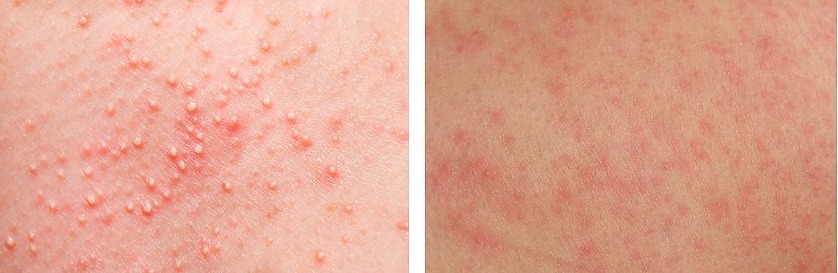 Scabs on Scalp: Everything You Need to Know - Wimpole Clinic