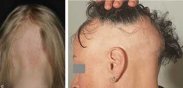 Types Of Alopecia: Causes, Symptoms, Treatments - Wimpole Clinic