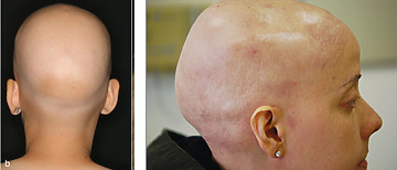 Types Of Alopecia: Causes, Symptoms, Treatments - Wimpole Clinic