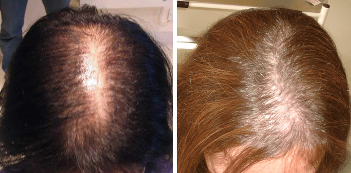 Types Of Alopecia: Causes, Symptoms, Treatments - Wimpole Clinic