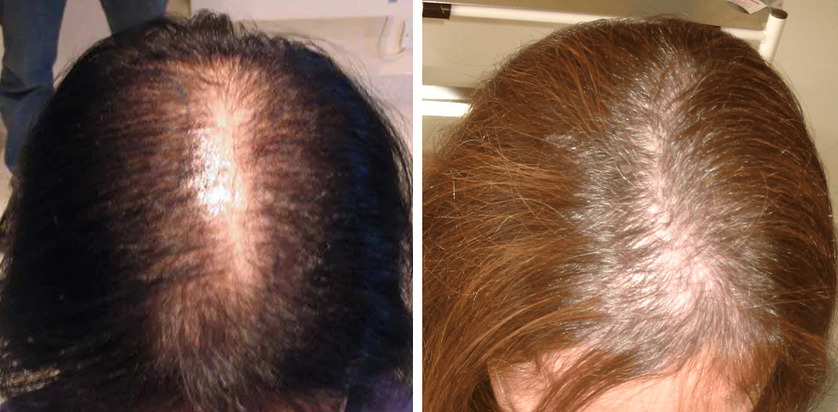 Types Of Alopecia: Causes, Symptoms, Treatments - Wimpole Clinic