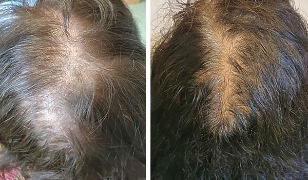Types Of Alopecia: Causes, Symptoms, Treatments - Wimpole Clinic