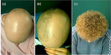 How To Stop Alopecia Areata From Spreading