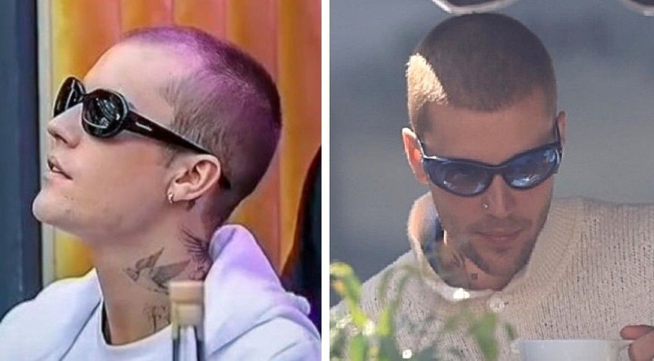Justin Bieber Hair Loss: Everything You Need To Know