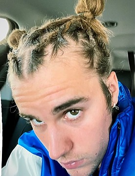 Justin Bieber Hair Loss: Everything You Need To Know