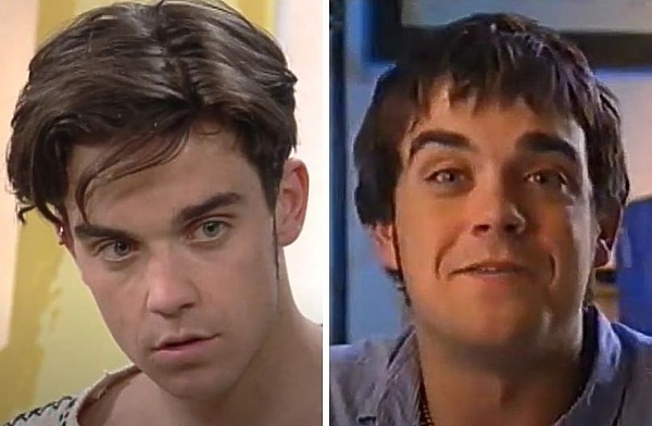 Robbie Williams Hair Transplant: Everything You Need To Know