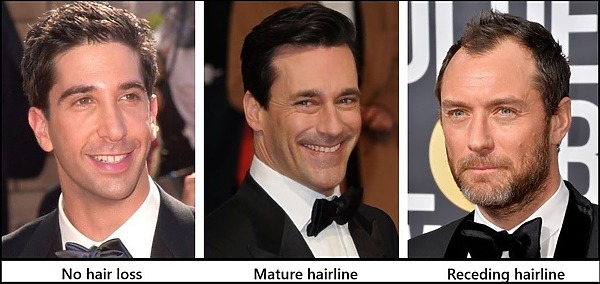 7 Ways To Tell Your Hairline Is Receding And The Best Treatments