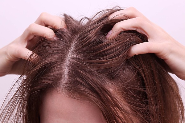 Yeast Infection on Scalp: Causes, Symptoms and Treatment