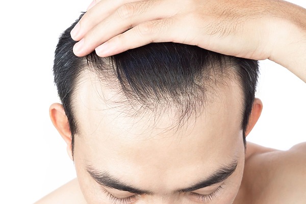 7 Ways to Tell Your Hairline is Receding (and Treatments)