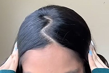 Normal Hair Parting Width vs Thinning: Causes and Treatments