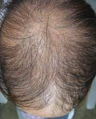 Ophiasis Alopecia: Causes, Symptoms and Treatments