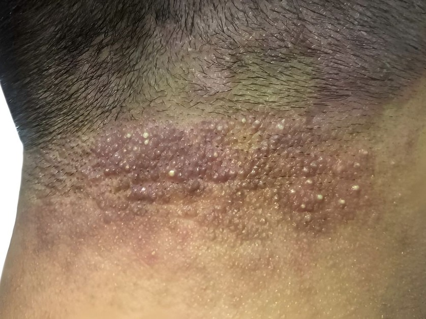 Traction Alopecia: Causes, Stages & Treatment Options