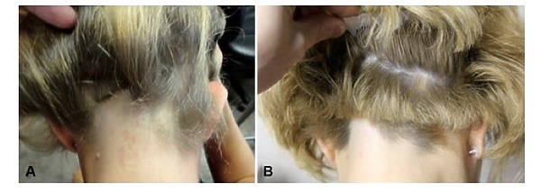 Ophiasis Alopecia: Causes, Symptoms and Treatments