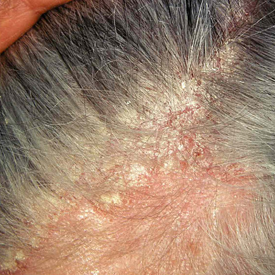 Recurring Scab On Scalp In The Same Spot: How to Treat