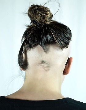 Ophiasis Alopecia: Causes, Symptoms and Treatments