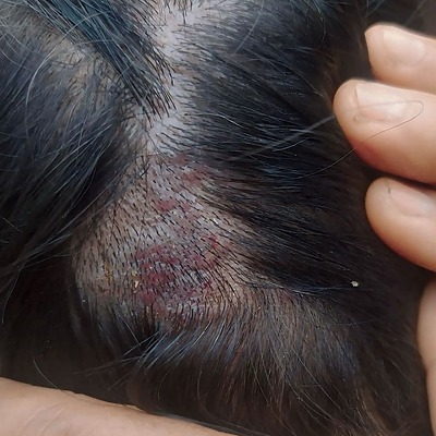 Seborrheic Dermatitis According to the NHS: Causes & Treatments