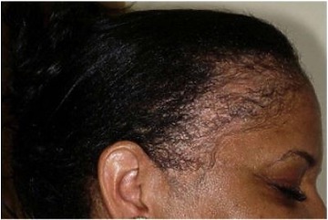 Female Temple Hair Loss: Causes, Prevention, Treatment