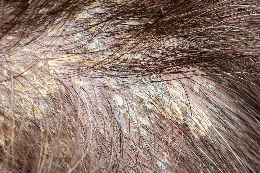 10 Reasons Your Hair Feels Thinner and How to Treat It