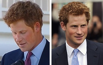 Prince Harry’s Hair Transplant – Did It Really Happen?