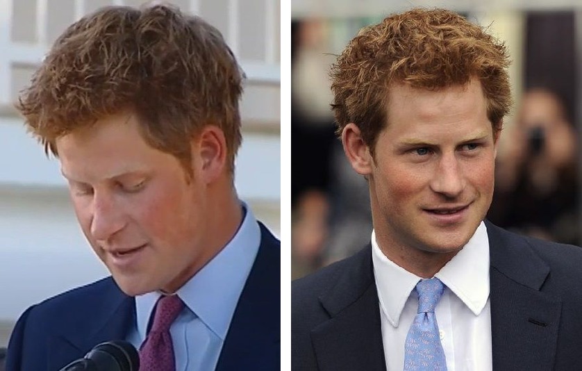 Prince Harry’s Hair Transplant – Did It Really Happen?