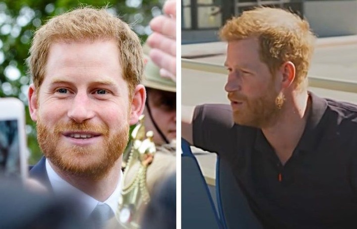 Prince Harry’s Hair Transplant - Everything You Need To Know