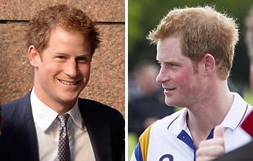 Prince Harry’s Hair Transplant – Did It Really Happen?