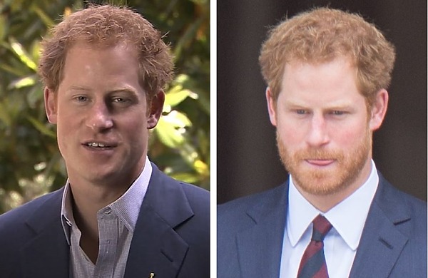 Prince Harry’s Hair Transplant – Did It Really Happen?