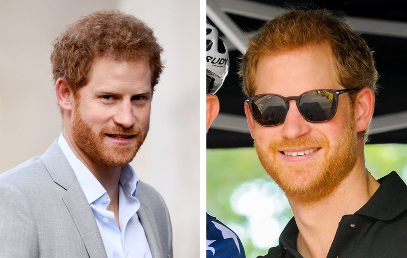 Prince Harry’s Hair Transplant - Everything You Need To Know