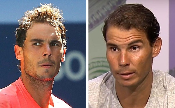 Rafael Nadal Hair Transplant: Everything You Need To Know