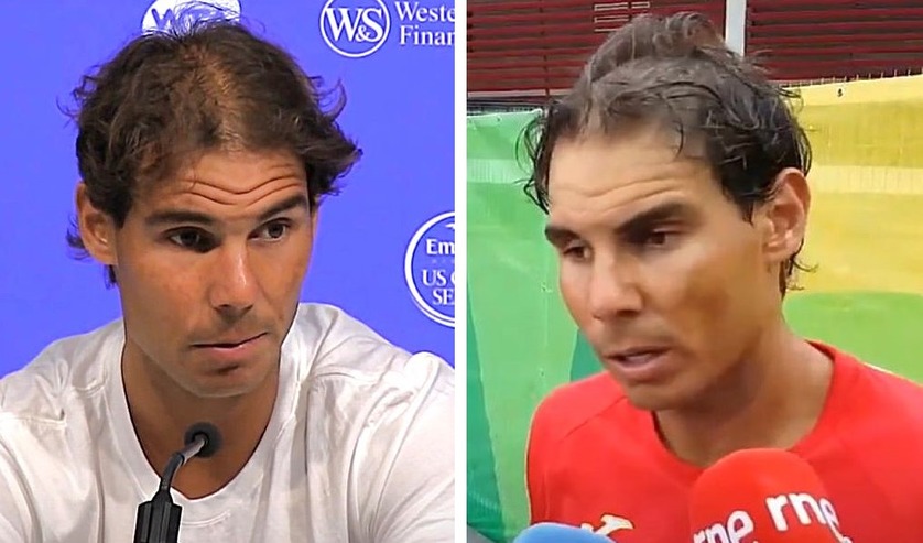 Rafael Nadal Hair Transplant: Everything You Need To Know