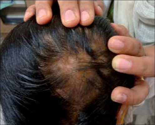 Steroid Injections for Hair Loss: Effectiveness, Risks & Benefits