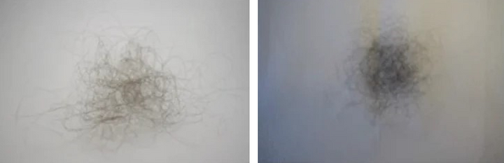 10 Most Common Causes of Teenage Hair Loss (and Treatments)