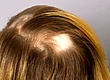 10 Most Common Causes of Teenage Hair Loss (and Treatments)