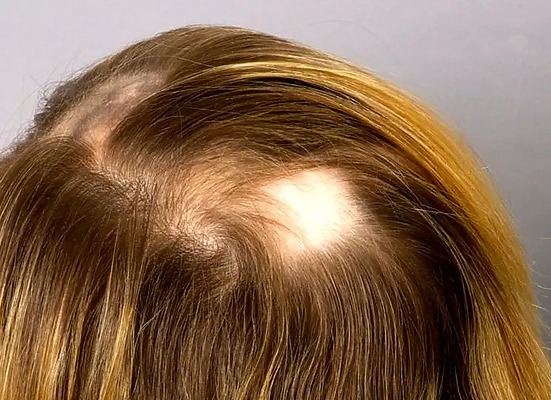10 Most Common Causes of Teenage Hair Loss (and Treatments)