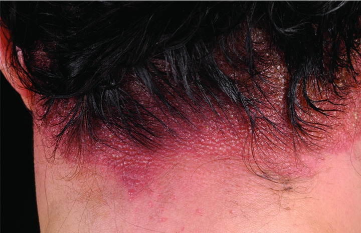 5 Reasons Your Scalp May Be Itching After a Hair Transplant - Wimpole ...