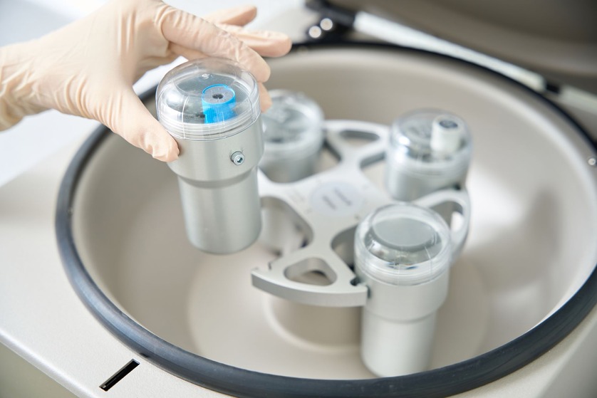 PRP Hair Treatment: Benefits, Costs, Side Effects & Results