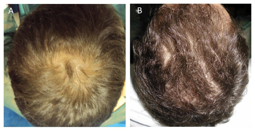 3 Months of PRP for Hair Loss: Photos, Results & Side Effects