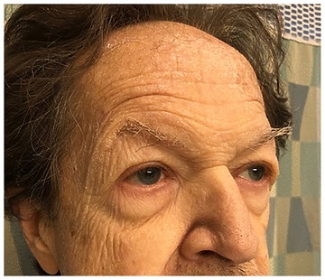 Thyroid Hair Loss: How To Spot Its Signs and Reverse It