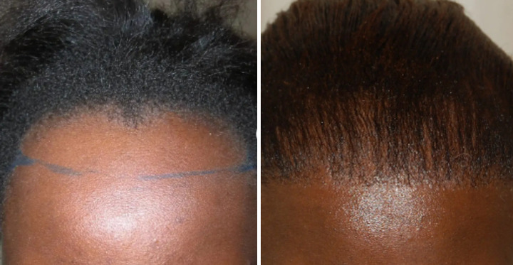 Can a Forehead Hair Transplant Improve Your Appearance?