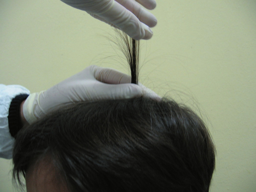 Hair Pull Test: Everything You Need To Know - Wimpole Clinic