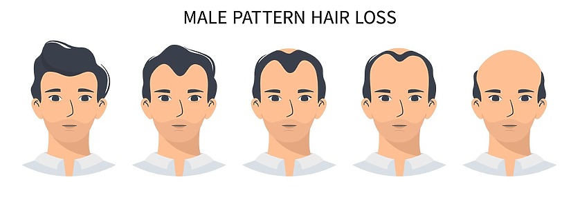 Do Headphones Cause Hair Loss?- Wimpole Clinic