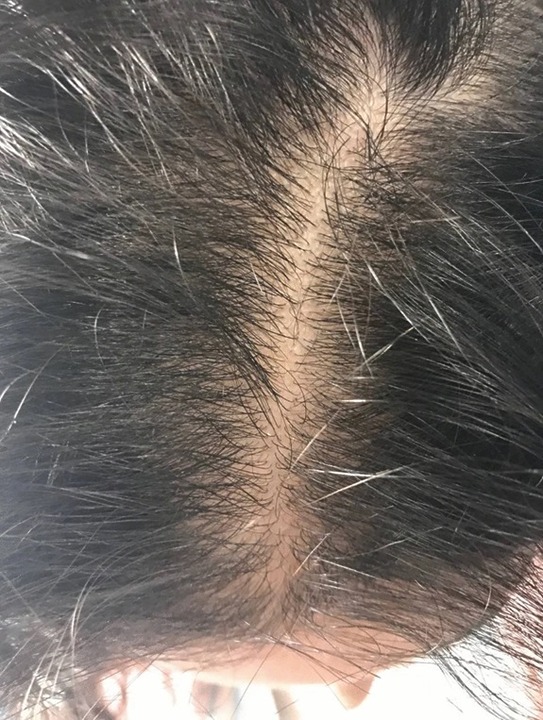 Thyroid Hair Loss: How To Spot Its Signs and Reverse It