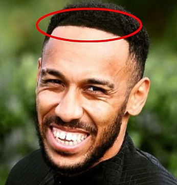 Aubameyang's Hair Transplant: Was it Surgery or Spray-on?