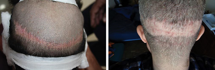 Hair Transplant Risks: Everything You Need to Know