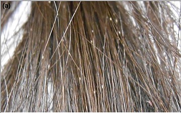 Could You Have a Beard Hair Loss Fungus? And Which One?