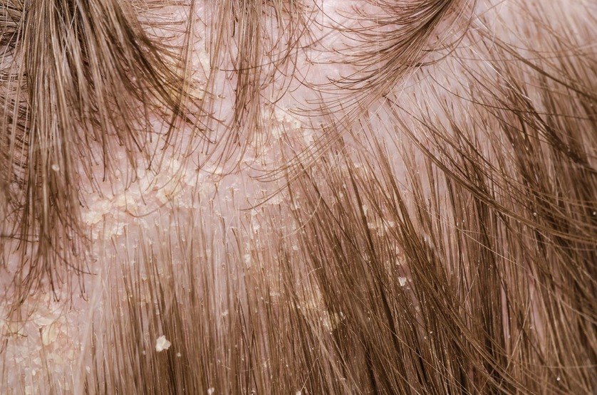 Does Dandruff Cause Hair Loss Everything You Need To Know
