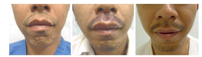 Moustache Transplant: Benefits, Costs, Risks and Results