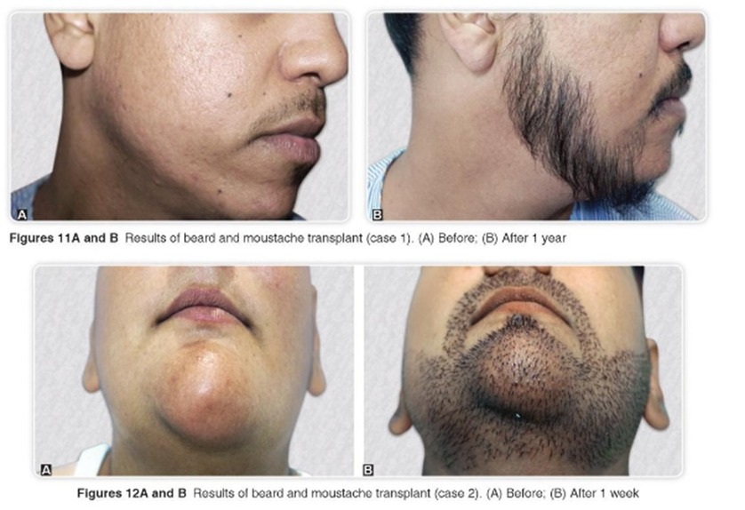 Moustache Transplant: Benefits, Costs, Risks and Results