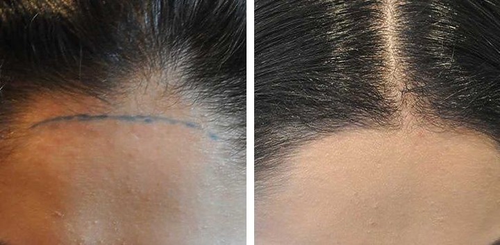 Permanent Hair Restoration for Women: How Does it Work?